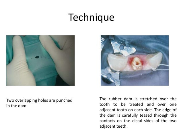 Rubber dam application