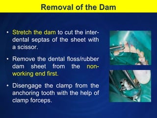 Rubber dam isloation | PPTX