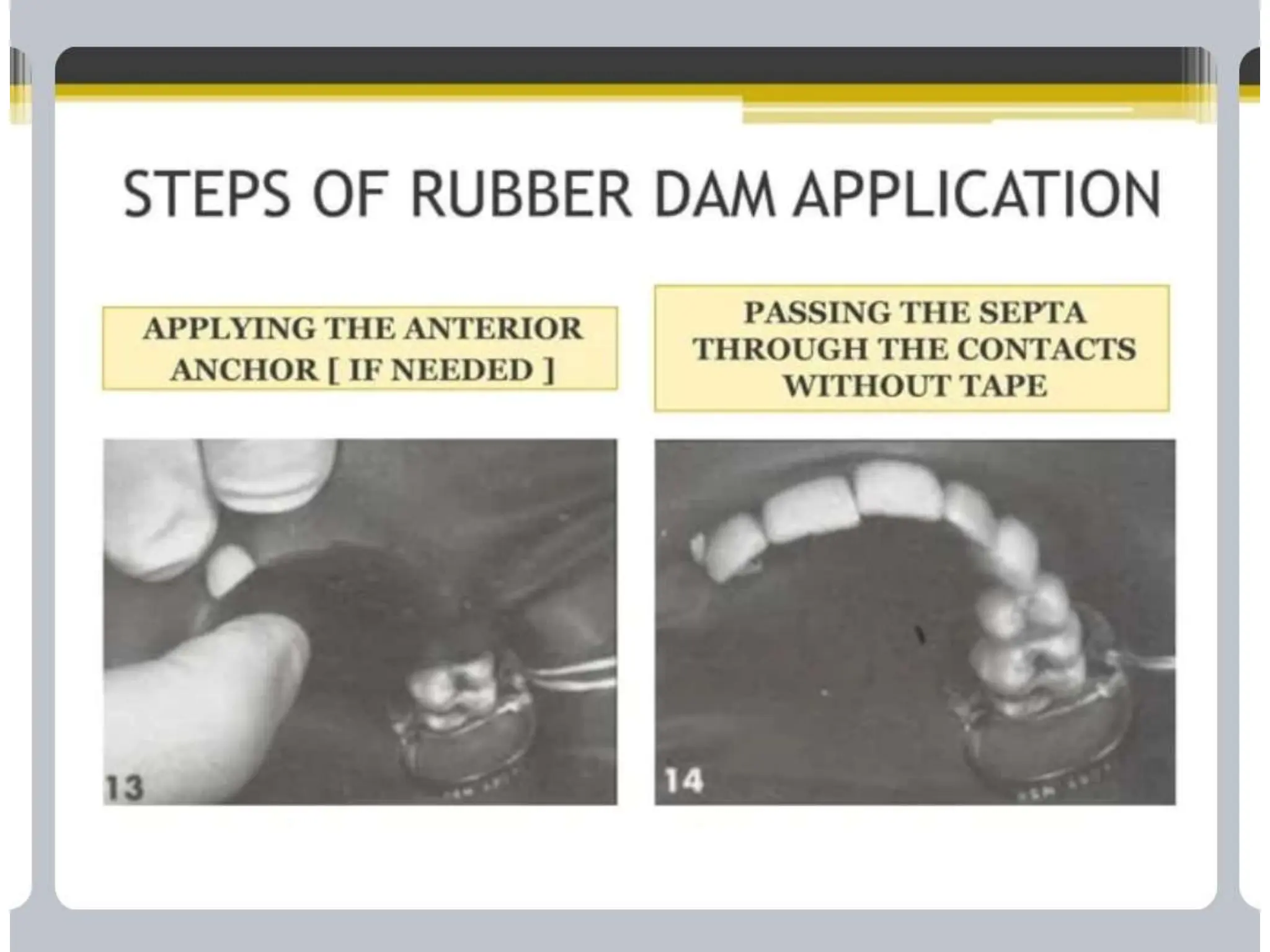 Rubber dam isolation oral cavity dr Muhammad Hasnain dental surgeon ...