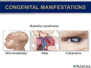 Congenital Rubella Pda