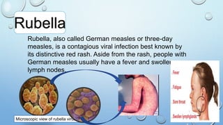 Rubella | PPTX