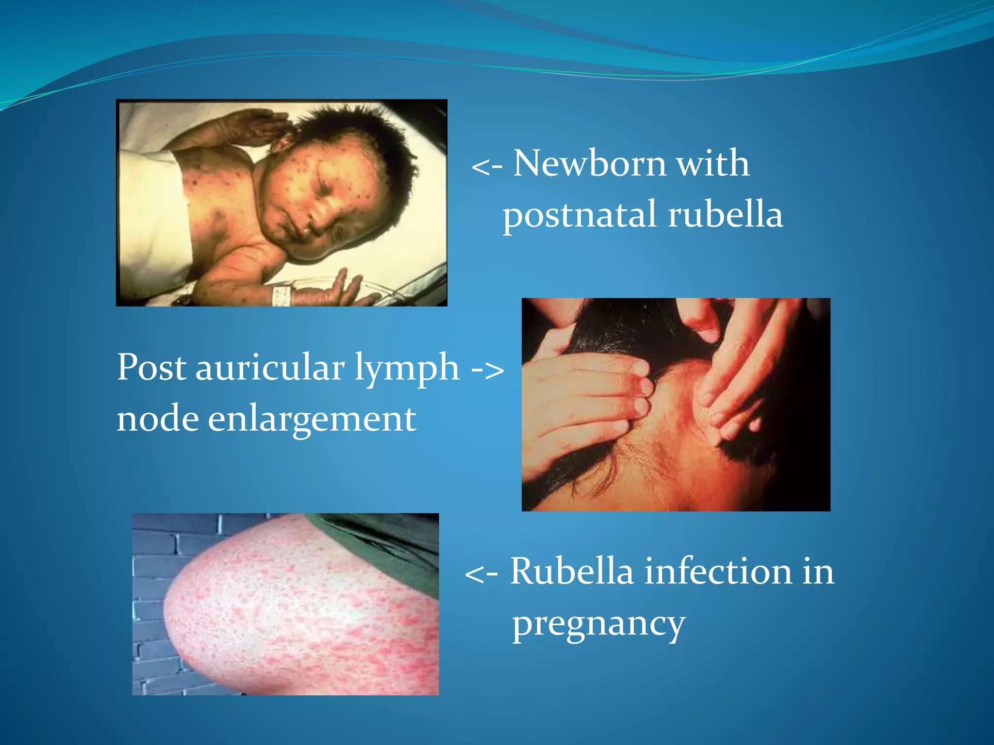 Rubella | PPTX