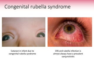 Rubella Cataract