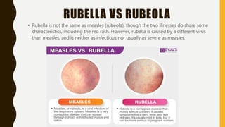 Rubella | PPTX
