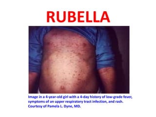 Rubella.pptx