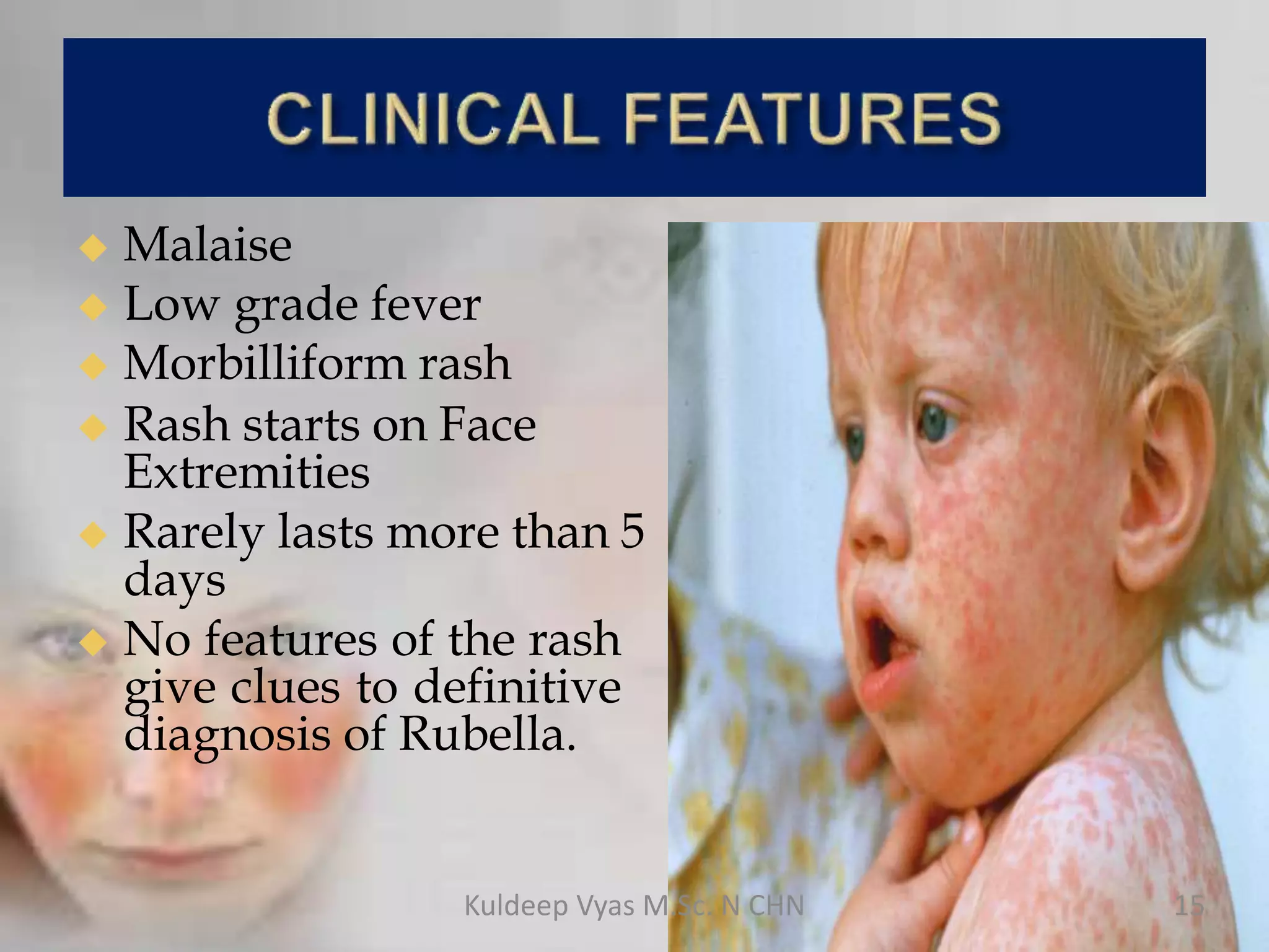 Rubella (German Measles) | PPTX