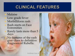 Rubella (German Measles) | PPTX