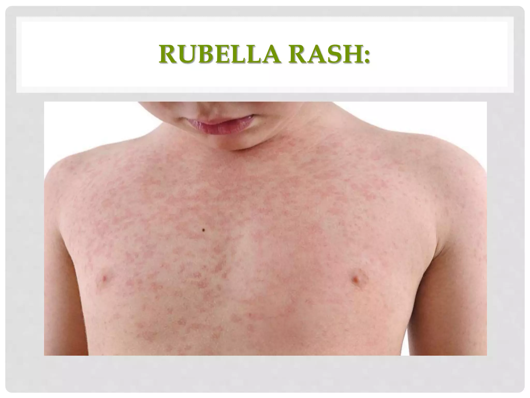 Rubella (german measles) | PPTX
