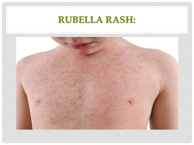 Rubella (german measles) | PPTX