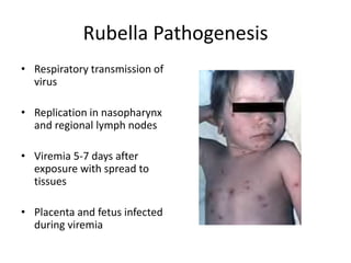 Rubella infection | PPT