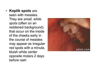 Rubella infection | PPT