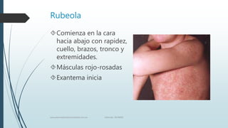 Rubeola | PPTX