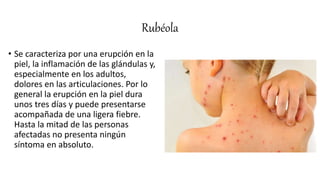 Rubeola | PPTX