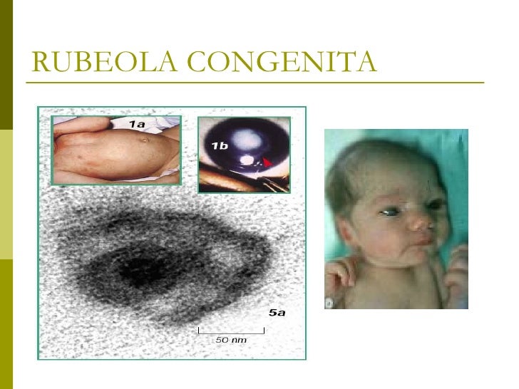 Rubeola congenita
