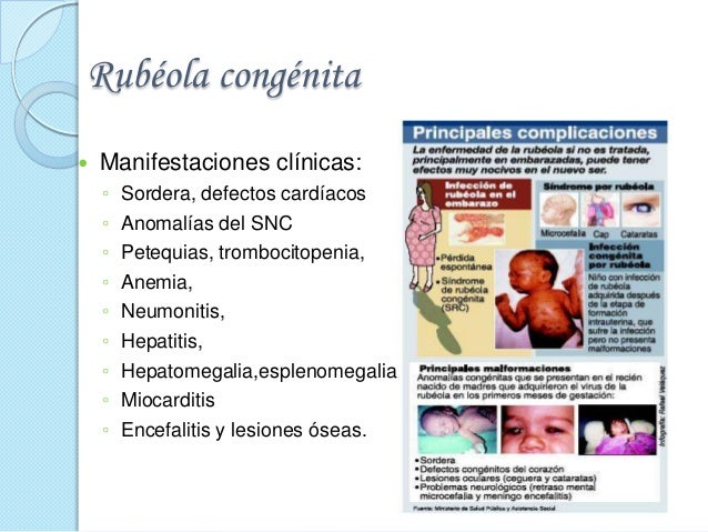 Rubeola congénita