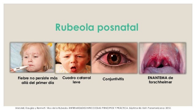 Rubeola infectologia