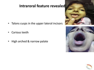 Rubinstein taybi syndrome | PPTX