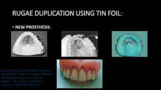 Rugae fabrication | PPTX