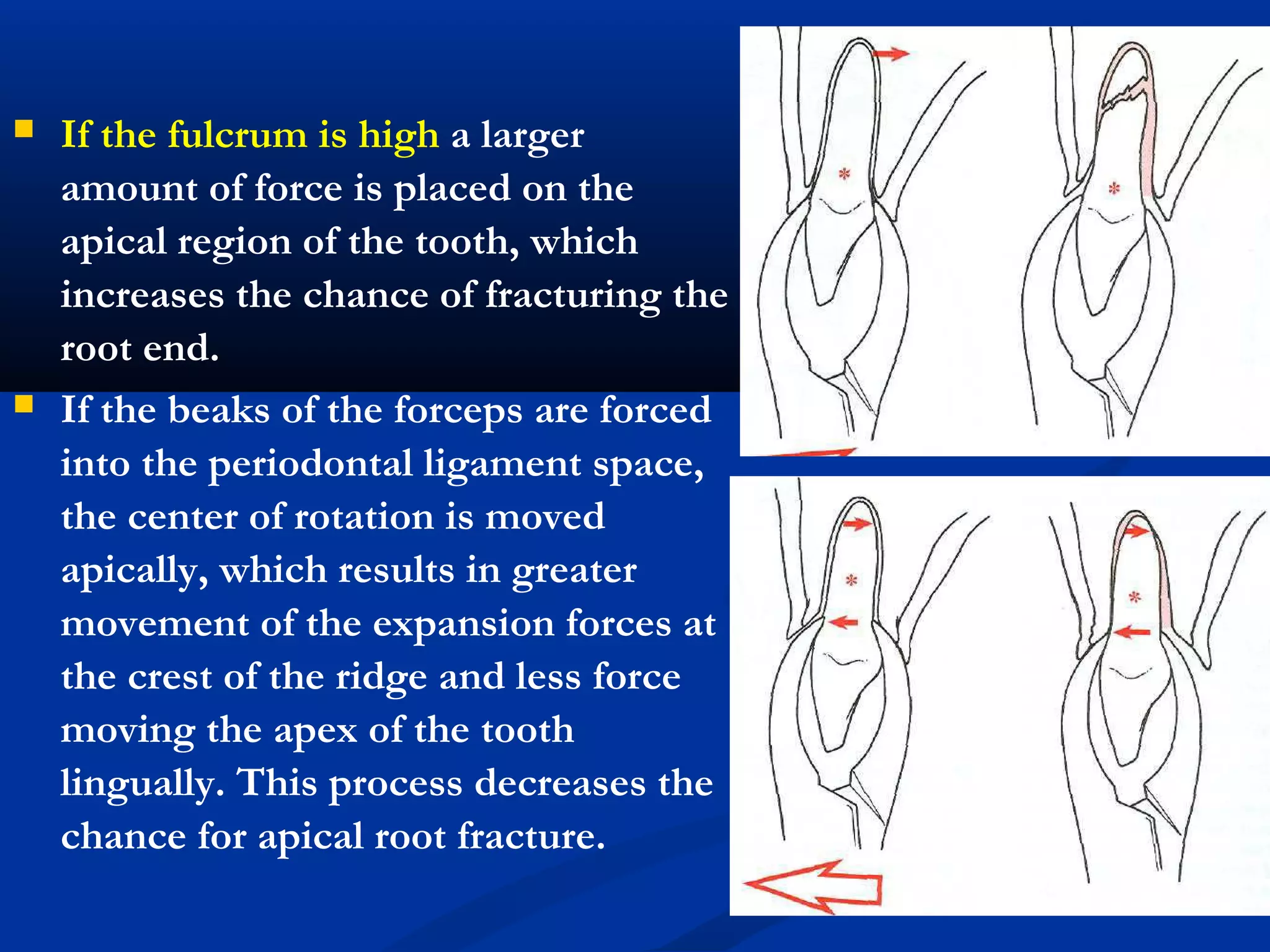 Rules of using dental forceps & elevator | PPT