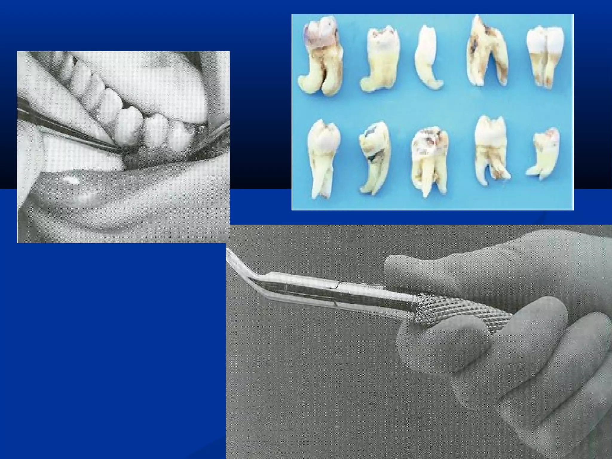 Rules of using dental forceps & elevator | PPT