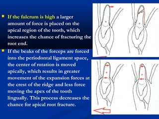 Rules of using dental forceps & elevator | PPT