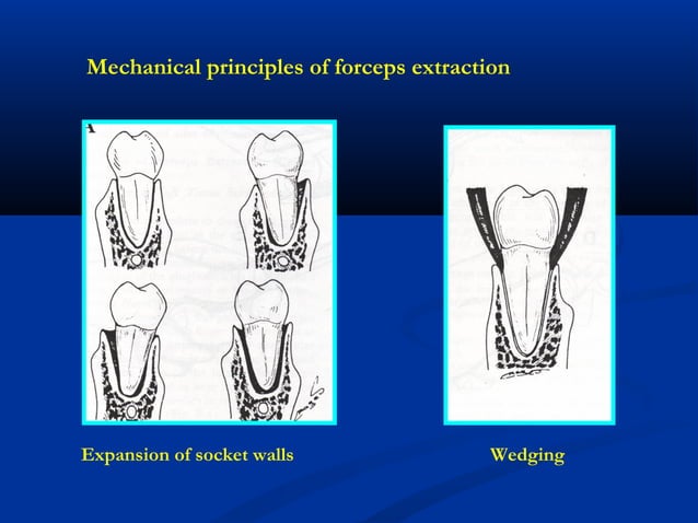 Rules of using dental forceps & elevator | PPT | Dental Health ...