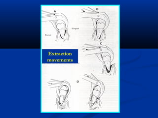 Rules of using dental forceps & elevator | PPT