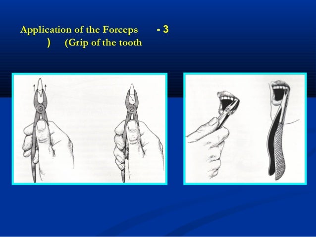 Rules of using dental forceps & elevator