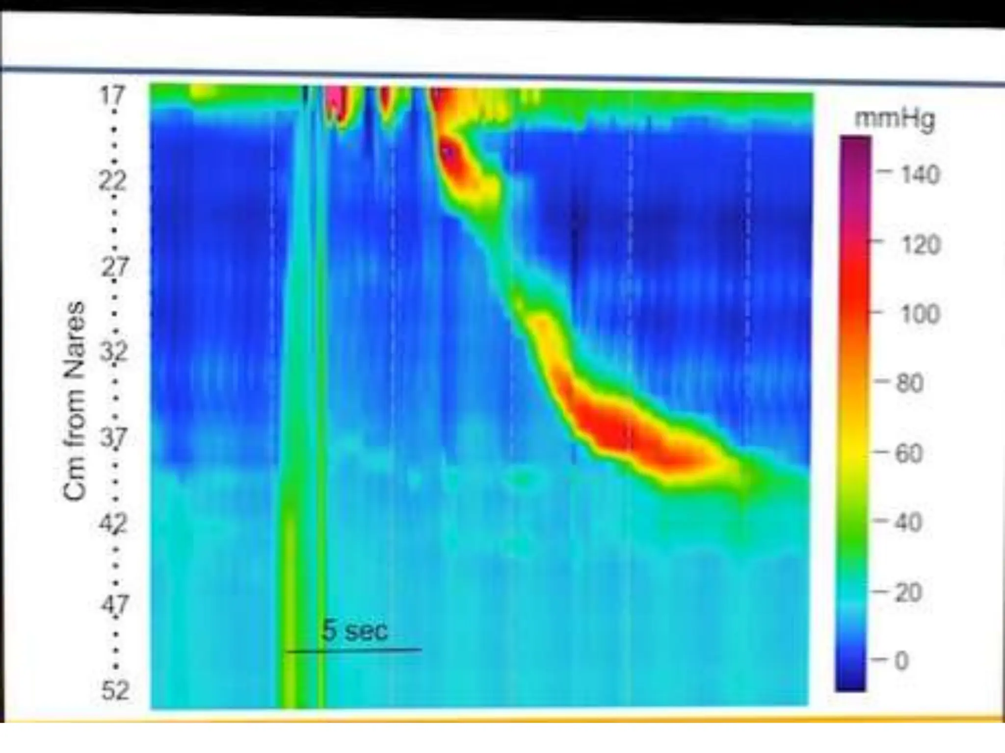RUMINATION SYNDROME, BELCHING, AEROPHAGIA.pptx | Digestive Disorders | Diseases and Conditions