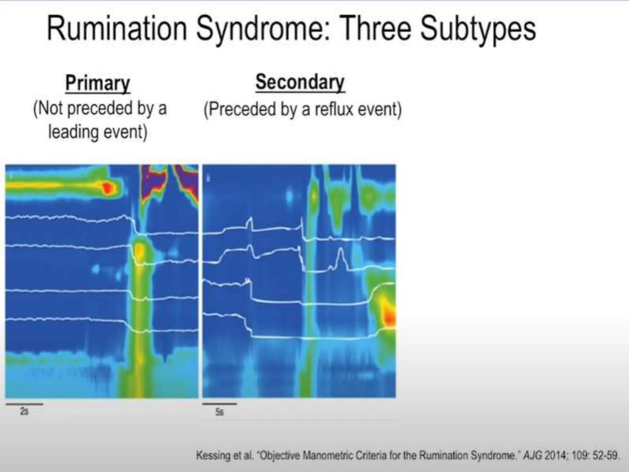RUMINATION SYNDROME, BELCHING, AEROPHAGIA.pptx | Digestive Disorders | Diseases and Conditions