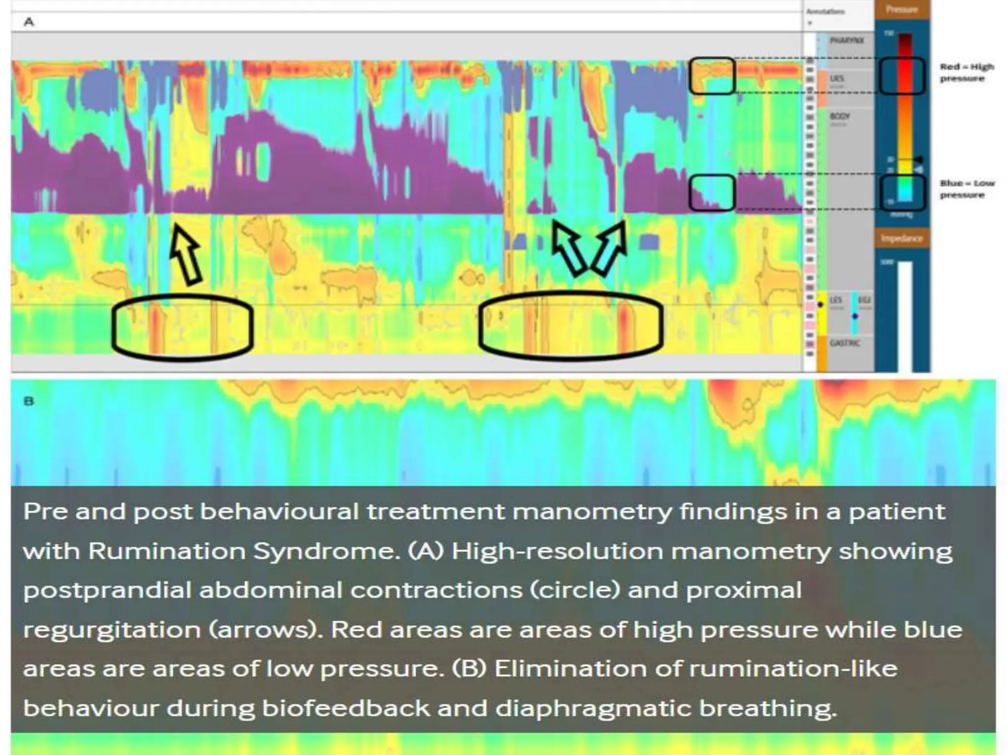 RUMINATION SYNDROME, BELCHING, AEROPHAGIA.pptx | Digestive Disorders | Diseases and Conditions
