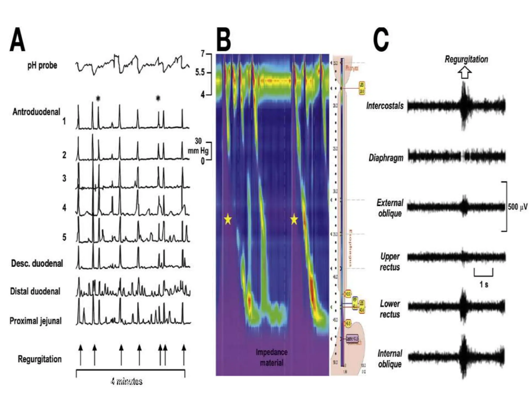 RUMINATION SYNDROME, BELCHING, AEROPHAGIA.pptx | Digestive Disorders | Diseases and Conditions