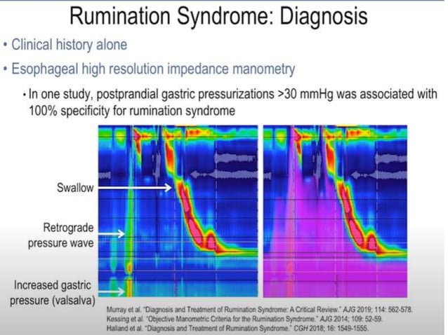 RUMINATION SYNDROME, BELCHING, AEROPHAGIA.pptx | Digestive Disorders | Diseases and Conditions