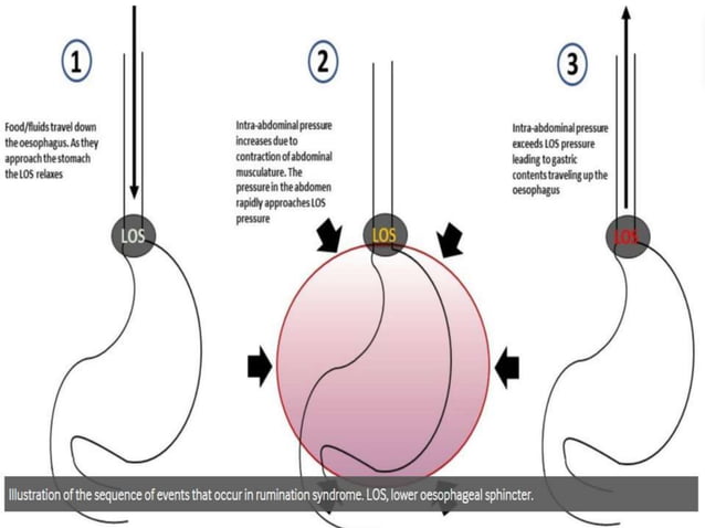 RUMINATION SYNDROME, BELCHING, AEROPHAGIA.pptx | Digestive Disorders | Diseases and Conditions