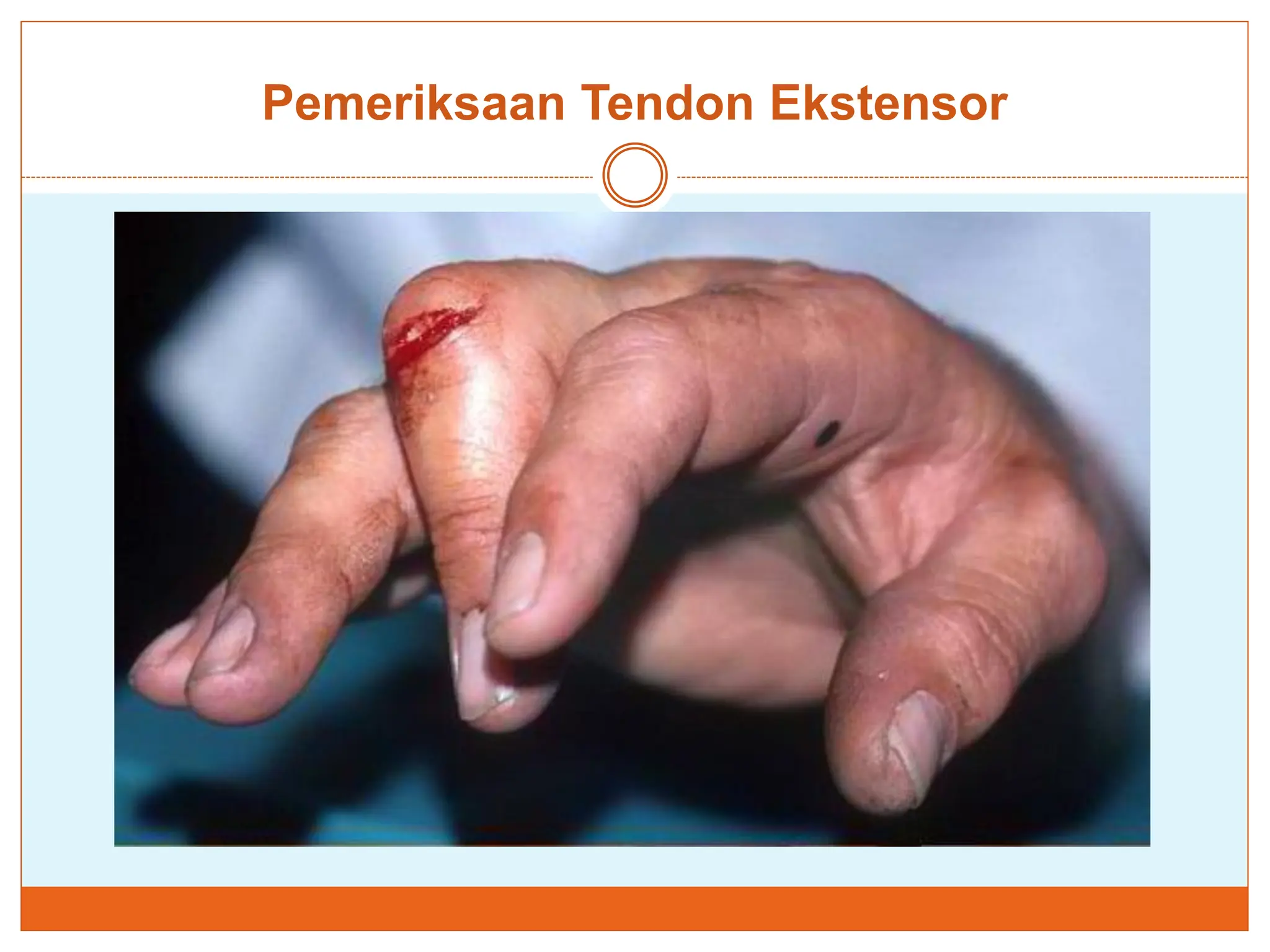 ruptur-tendon-baru_compress tangan | PDF