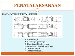 ruptur-tendon-baru_compress tangan | PDF
