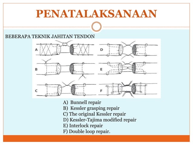 ruptur-tendon-baru_compress tangan | PDF