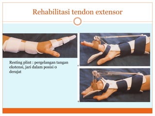ruptur-tendon-baru_compress tangan | PDF