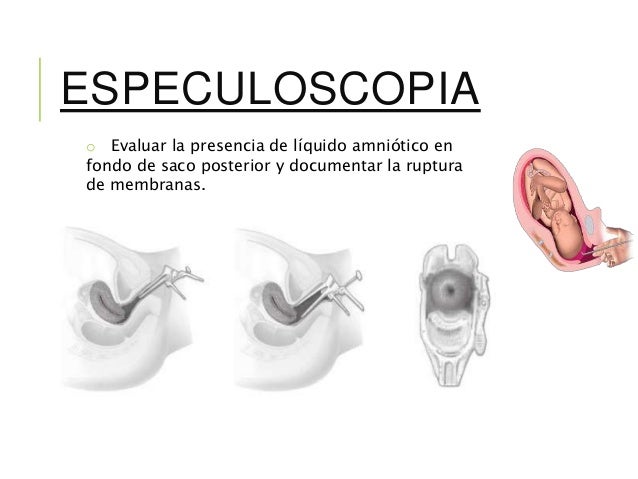 Ruptura prematura de membranas