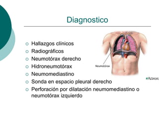 Ruptura y perforacion esofagica | PPTX