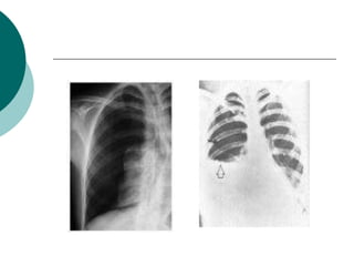 Ruptura y perforacion esofagica | PPTX