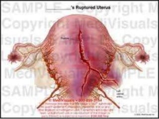 rupture-of-the-uterus.ppt