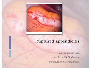 Rupture appendicitis | PPTX