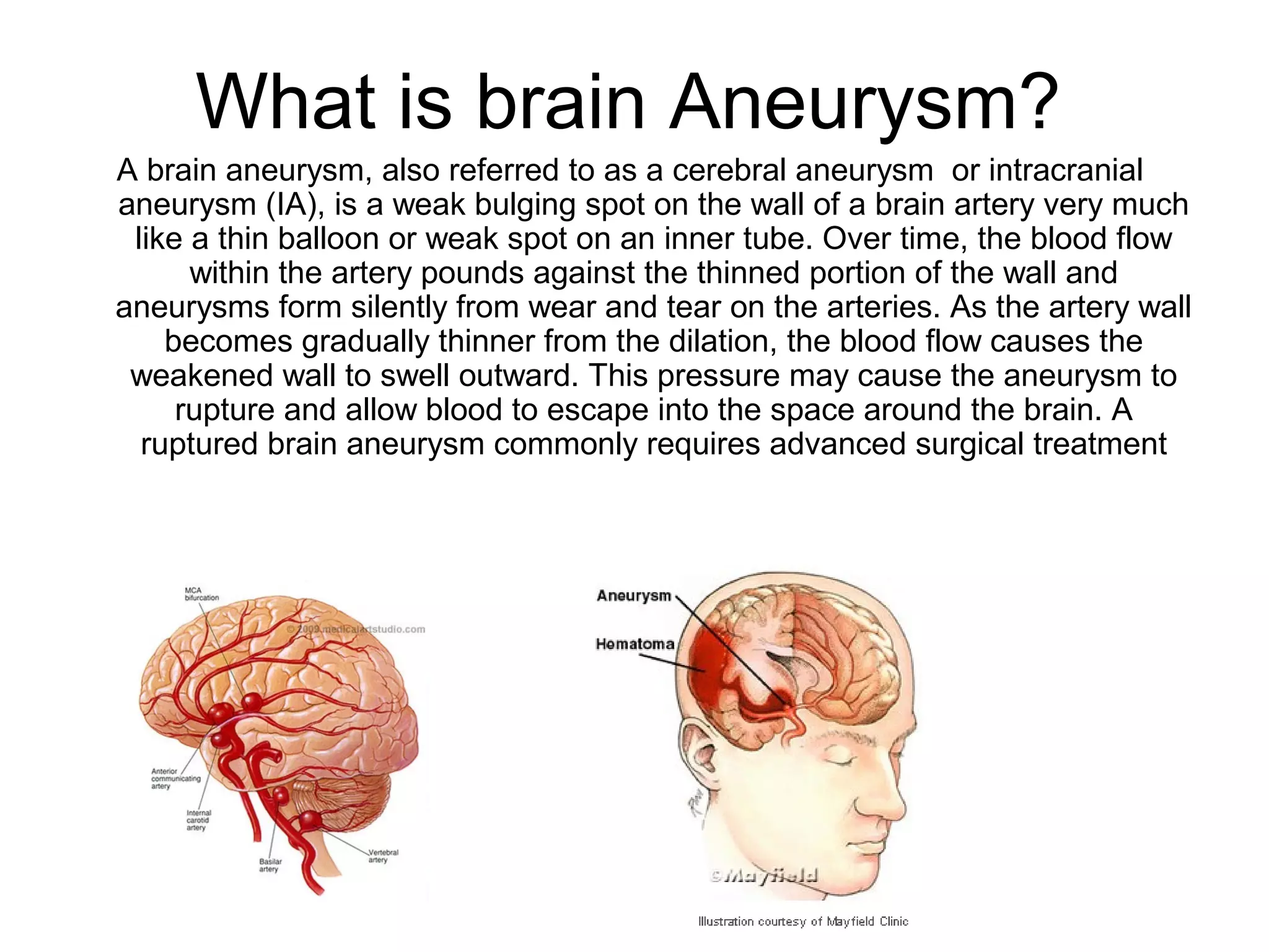 Ruptured brain aneurysm | PPT