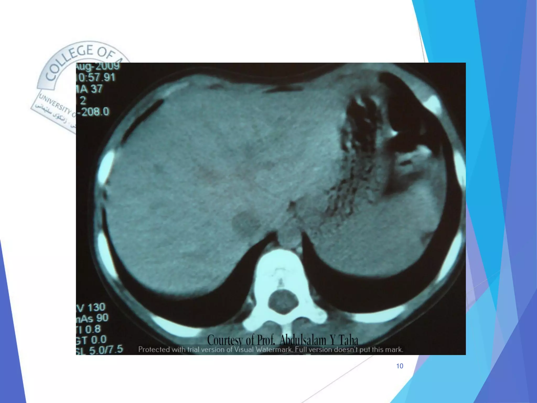 Ruptured Hydatid Cyst of the Right Lower Pulmonary Lobe in a Child.pdf