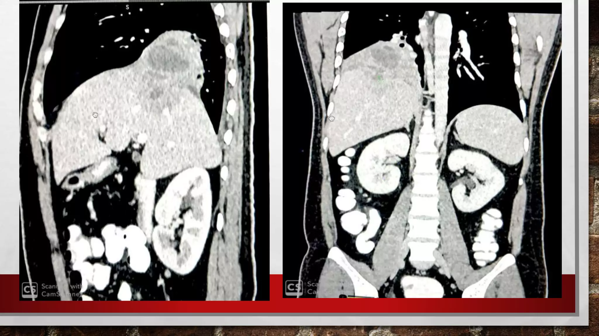 ruptured liver abscess.pptx