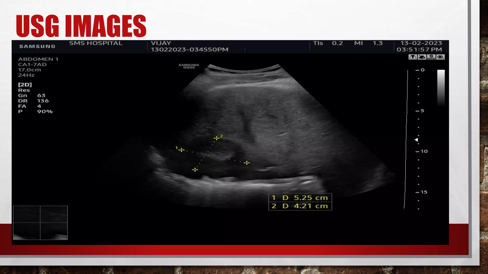 ruptured liver abscess.pptx