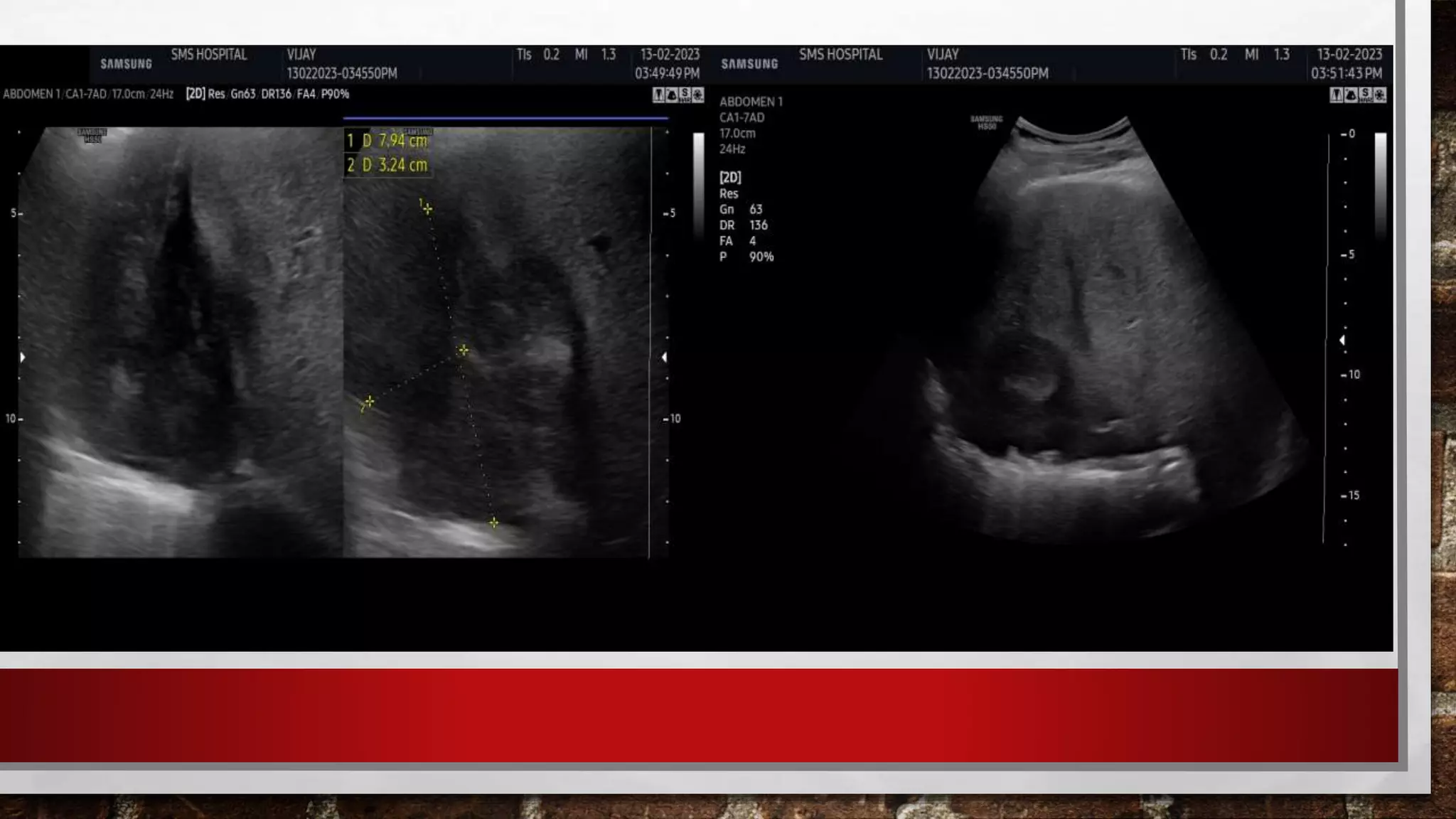 ruptured liver abscess.pptx