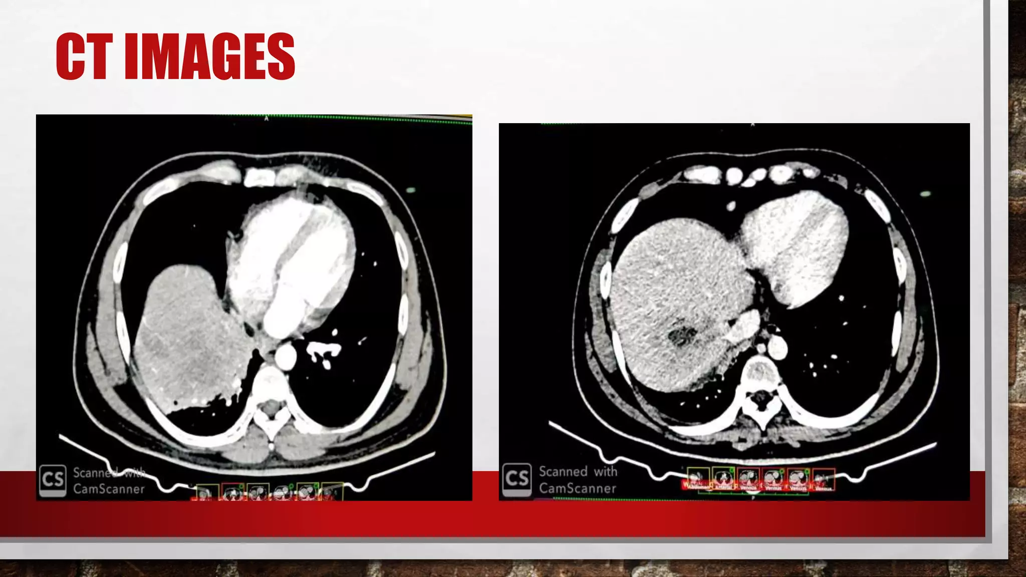 ruptured liver abscess.pptx
