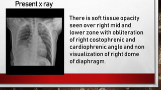 ruptured liver abscess.pptx